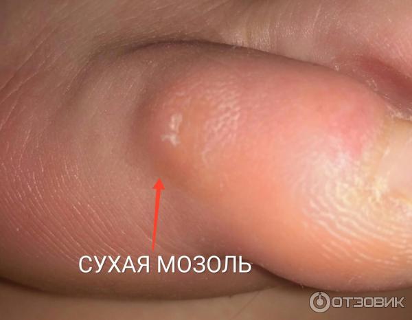 Отзыв о Лейкопластырь "Доктор Мозолькин" | Слабый эффект
